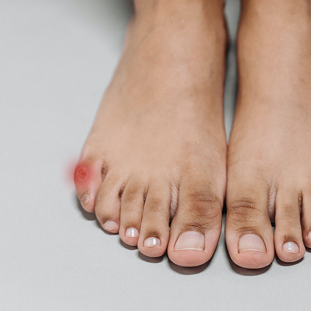 Produkter mod ligtorn – Minfot